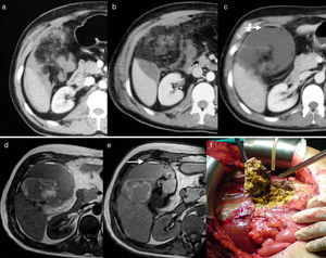 Necrosis grasa intraabdominal | Radiología