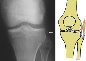 Radiología de las fracturas: algo más que un trazo | Radiología