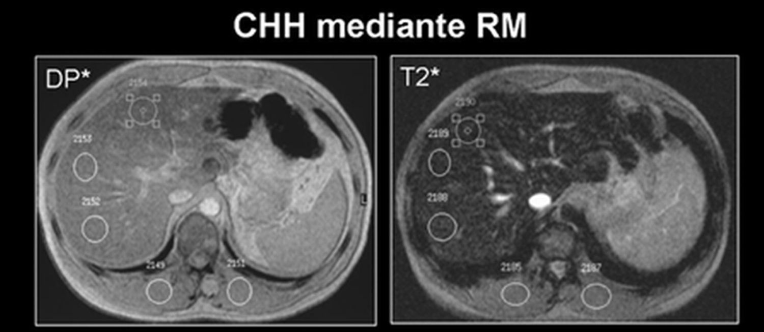 Medici n Del T2 Hep tico Y Card aco En La Hemocromatosis Secundaria medici-n-del-t2-hep-tico-y-card-aco-en-la-hemocromatosis-secundaria