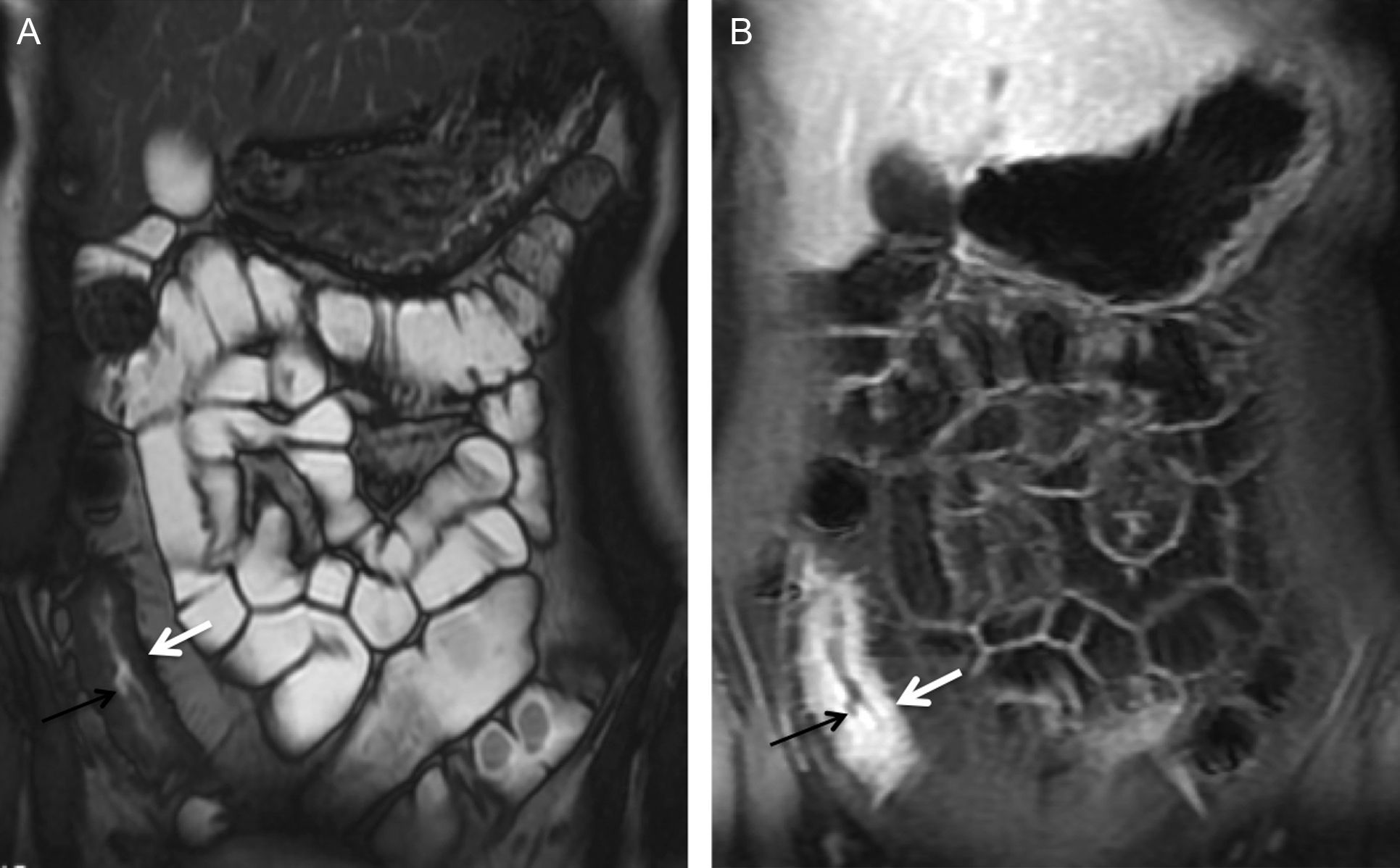 Enterografía por resonancia magnética: técnica e indicaciones ...
