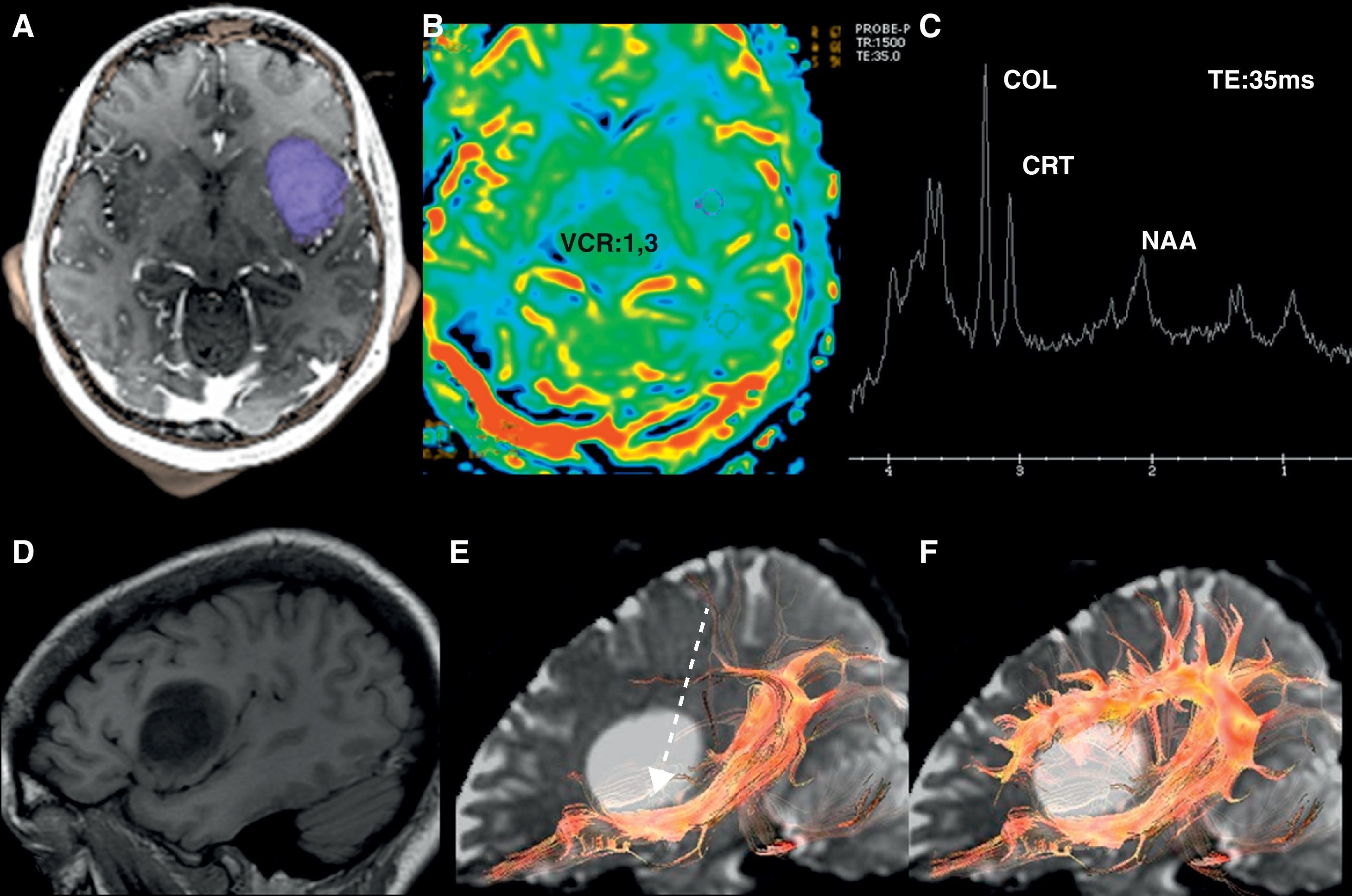 Mapa cortical y subcortical del lenguaje. Correlación de la resonancia magnética funcional y ...