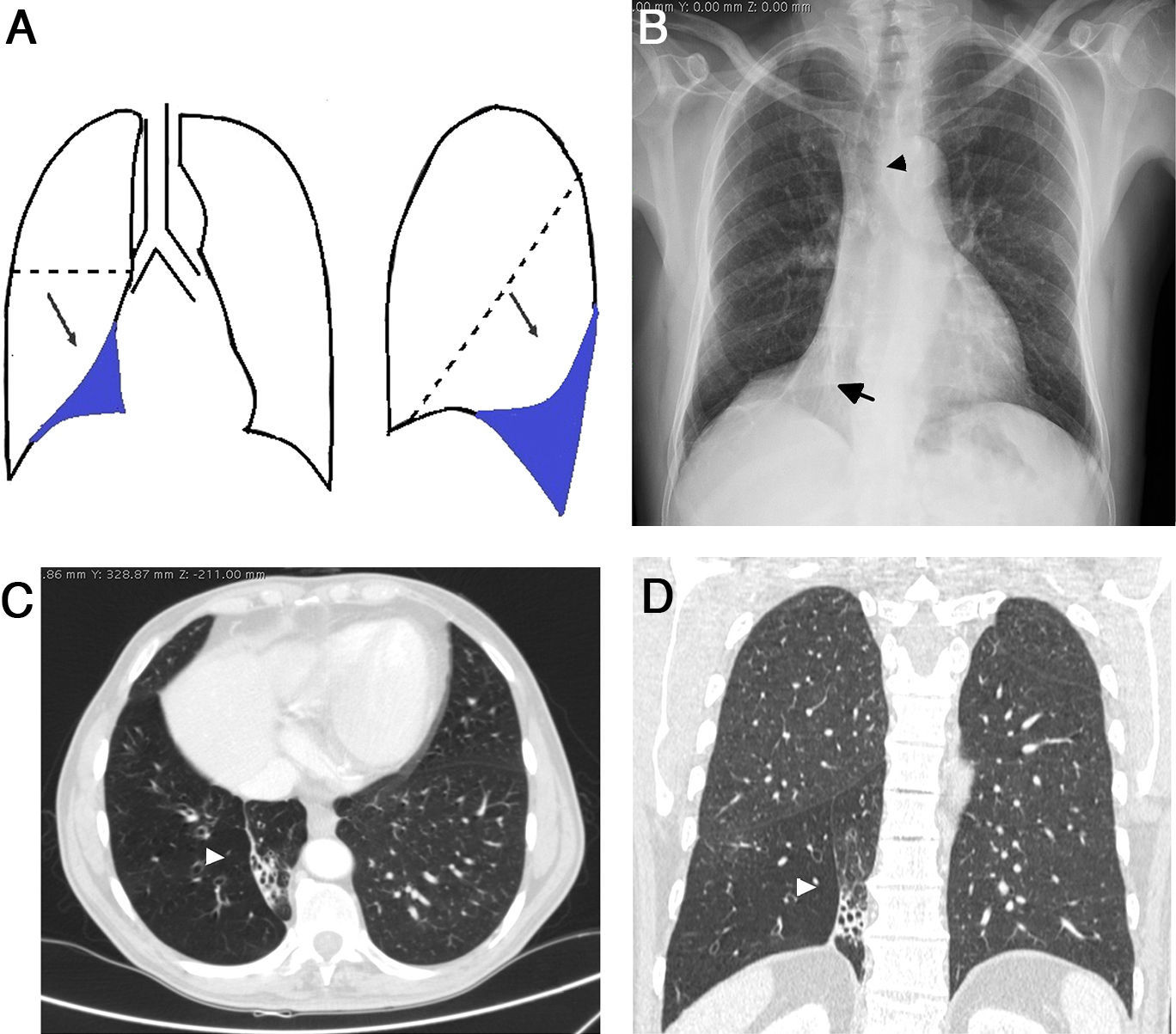 Manifestaciones radiográficas de las atelectasias pulmonares lobares en ...