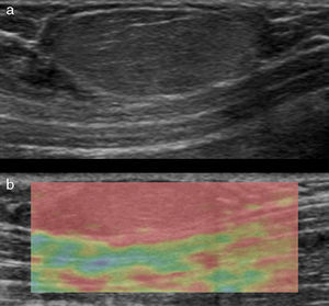 La elastografía: una nueva aplicación de la ecografía. ¿Cuál es su ...