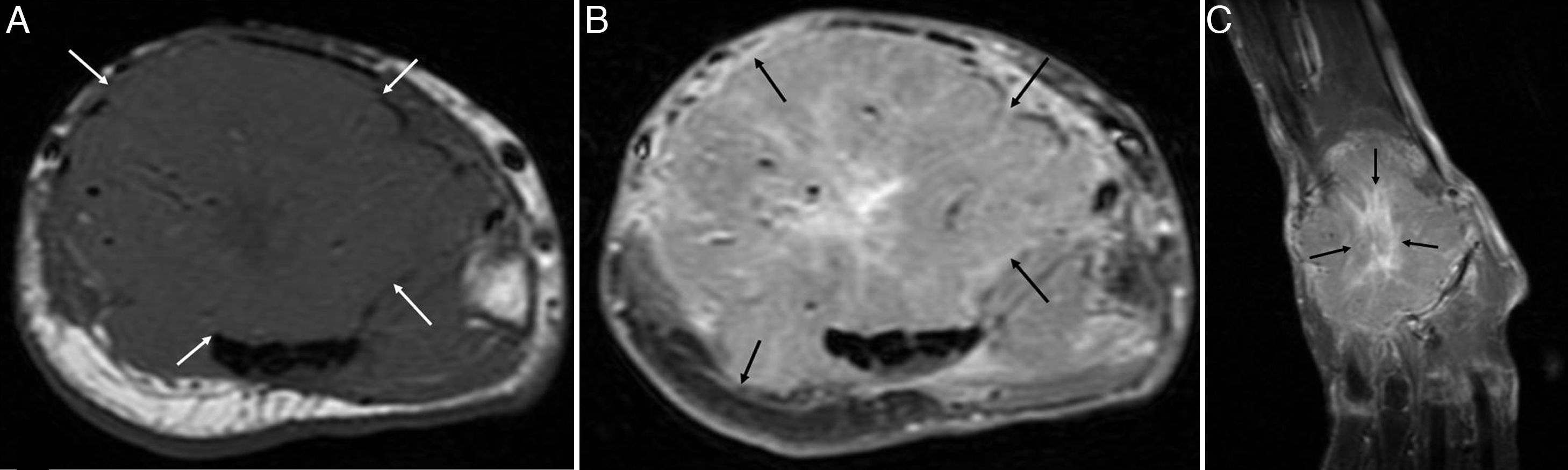 Metástasis única en los huesos carpianos como primera manifestación ...