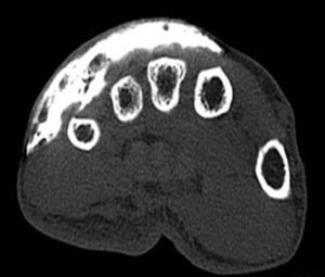 Administración de contrastes intravenosos: las extravasaciones | Radiología