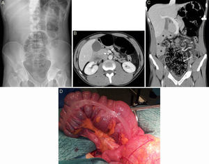 Malrotación-vólvulo intestinal: hallazgos radiológicos | Radiología