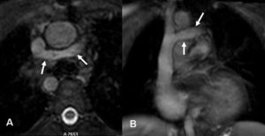 Vena innominada subaórtica en resonancia magnética | Radiología