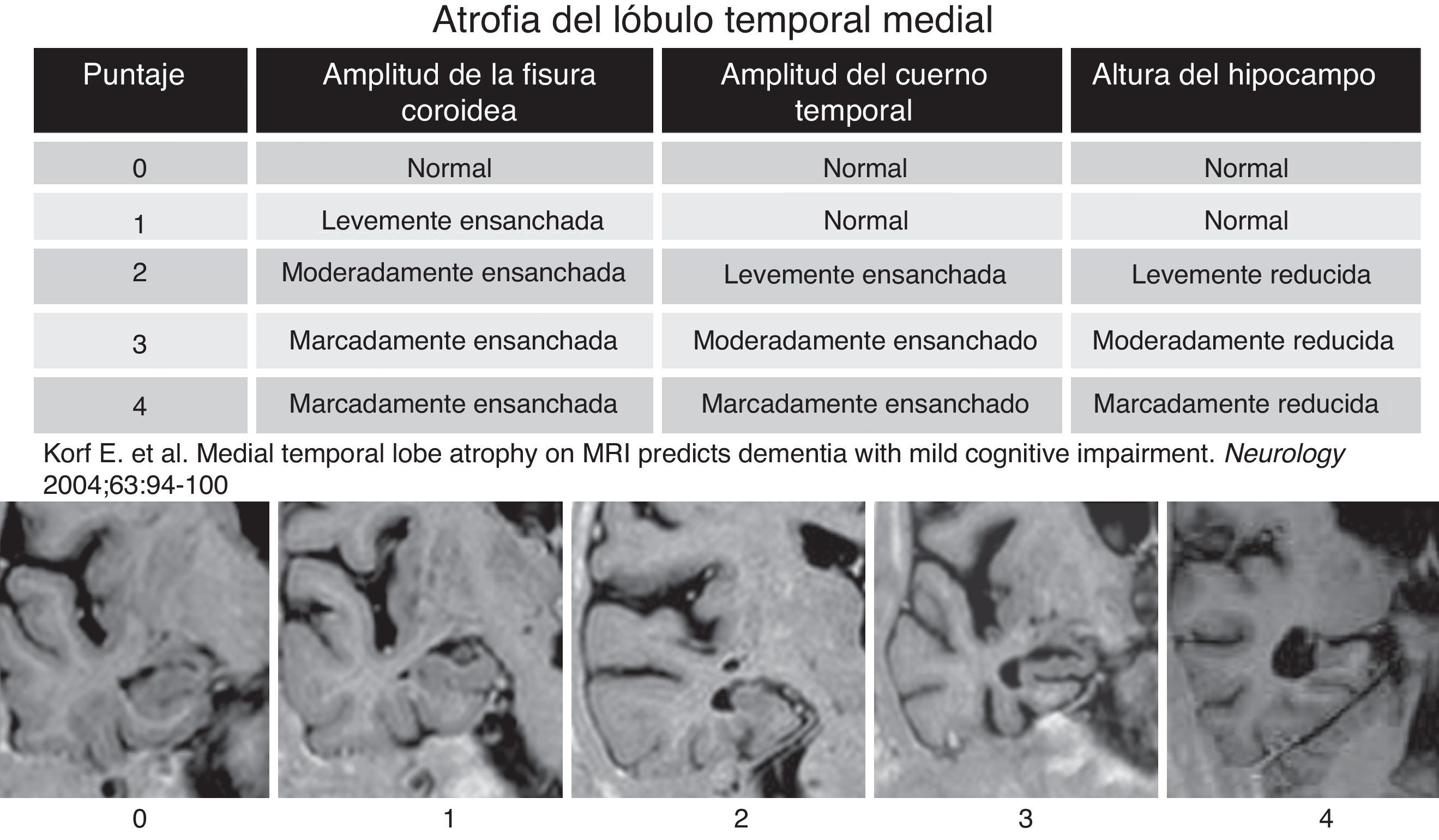 Reproducibilidad de la valoración cualitativa de la atrofia del lóbulo ...