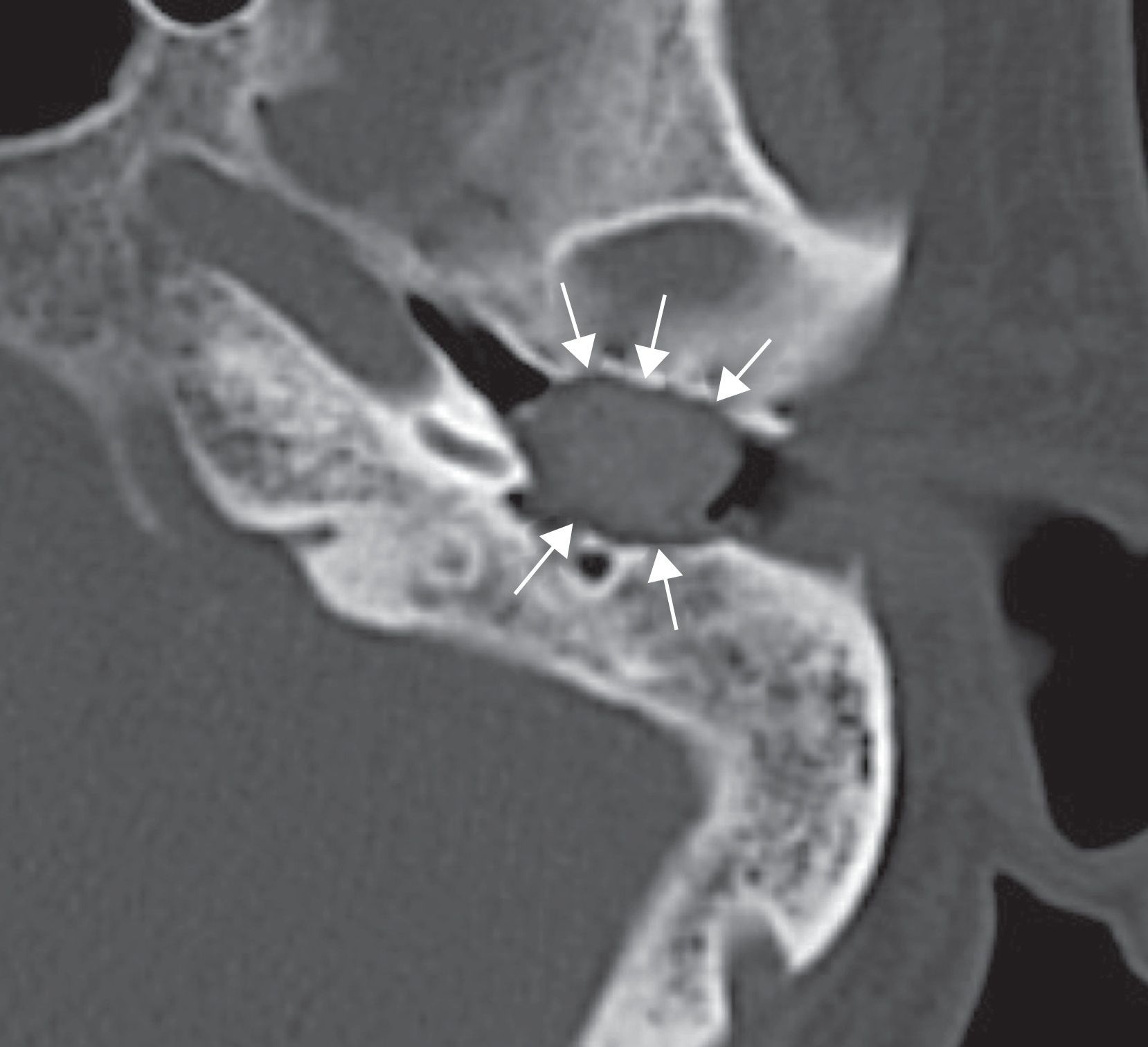 Radiología del oído externo: indicaciones, anatomía normal y procesos ...