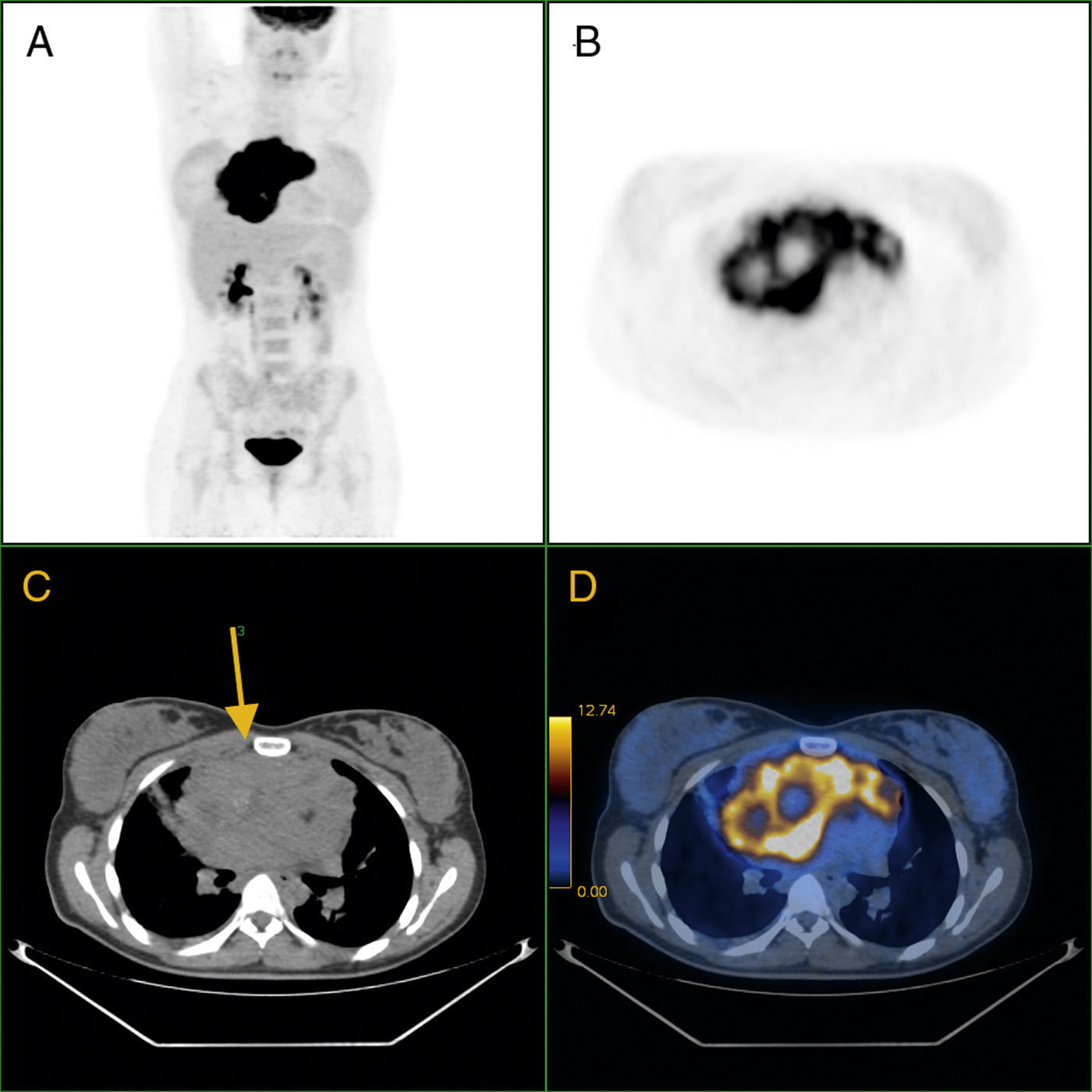 Tomografía por emisión de positrones con 18F-FDG en oncología ...