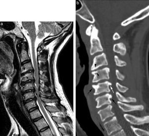 La columna cervical degenerativa | Radiología