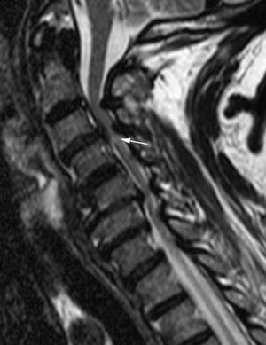 La columna cervical degenerativa | Radiología