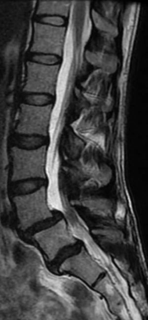Patología degenerativa en la columna lumbar | Radiología