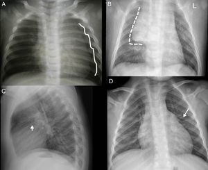Pitfalls y variantes del tórax pediátrico | Radiología