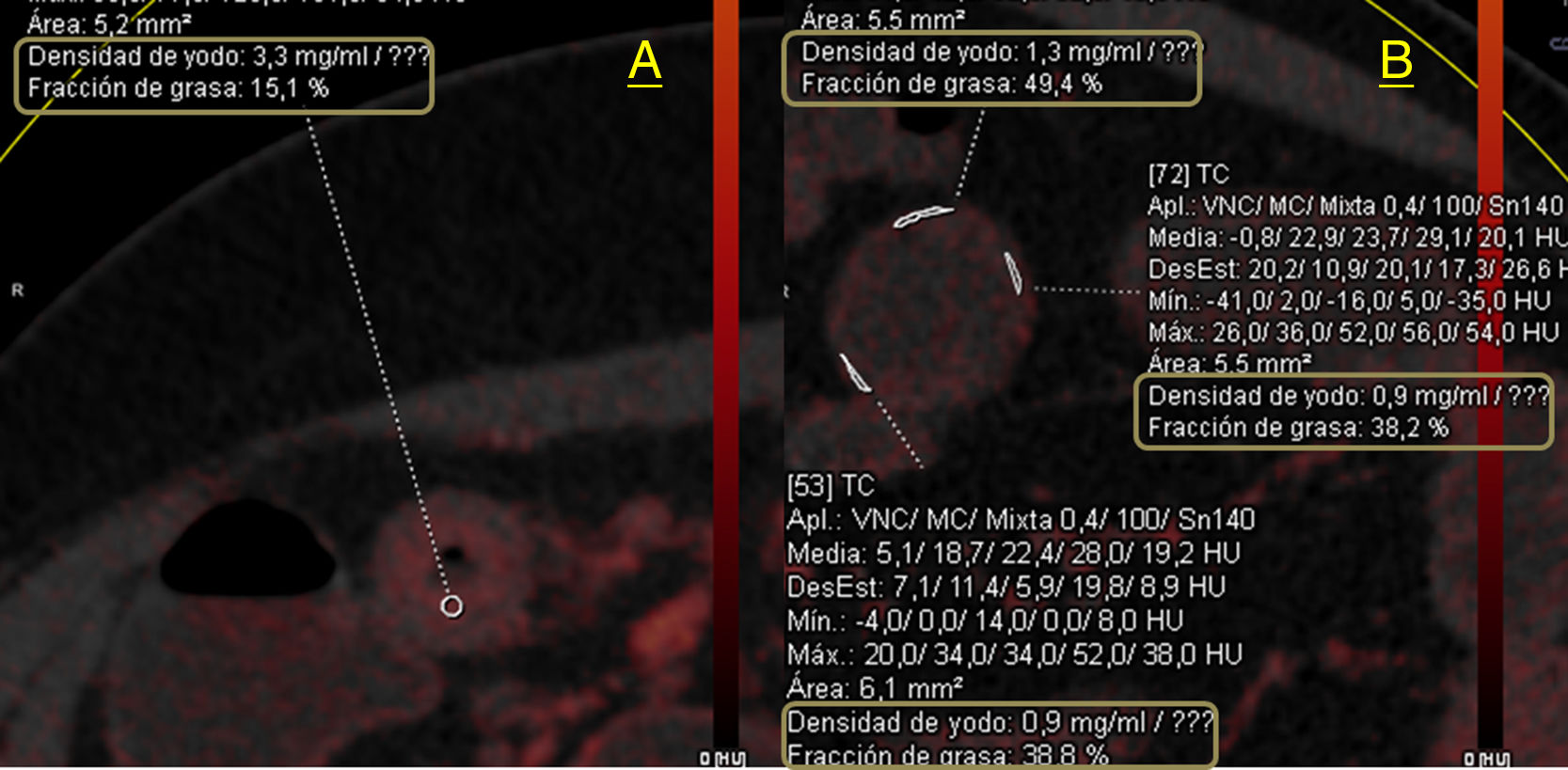 Valor de la enterografía por tomografía computarizada con doble energía ...