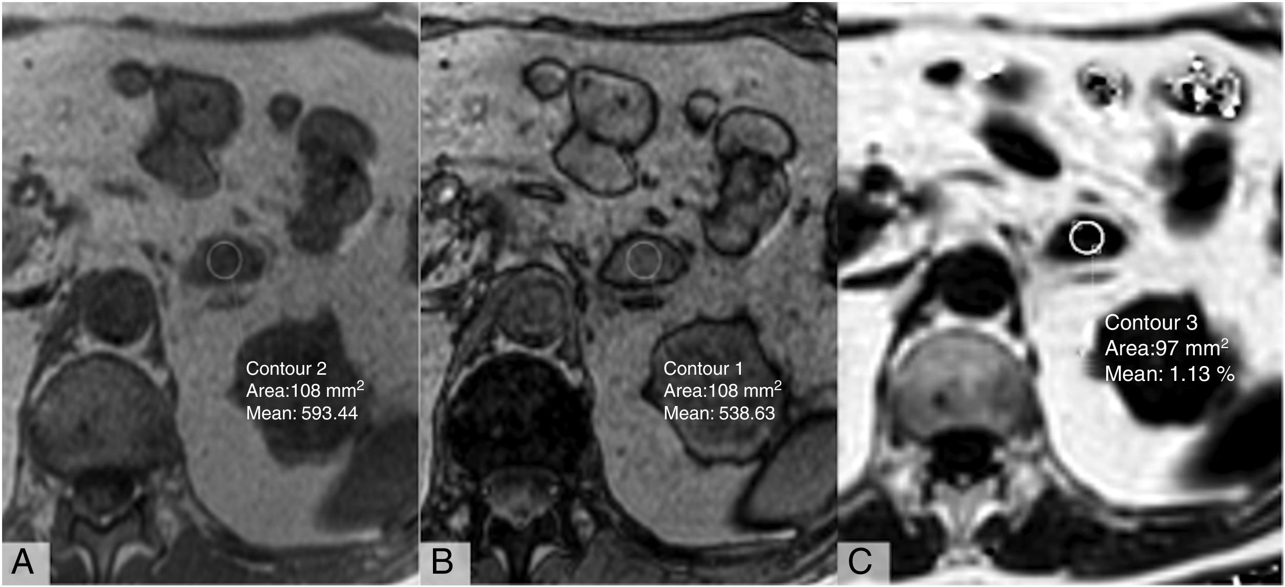 Valoración mediante Dixon modificado de las lesiones suprarrenales ...