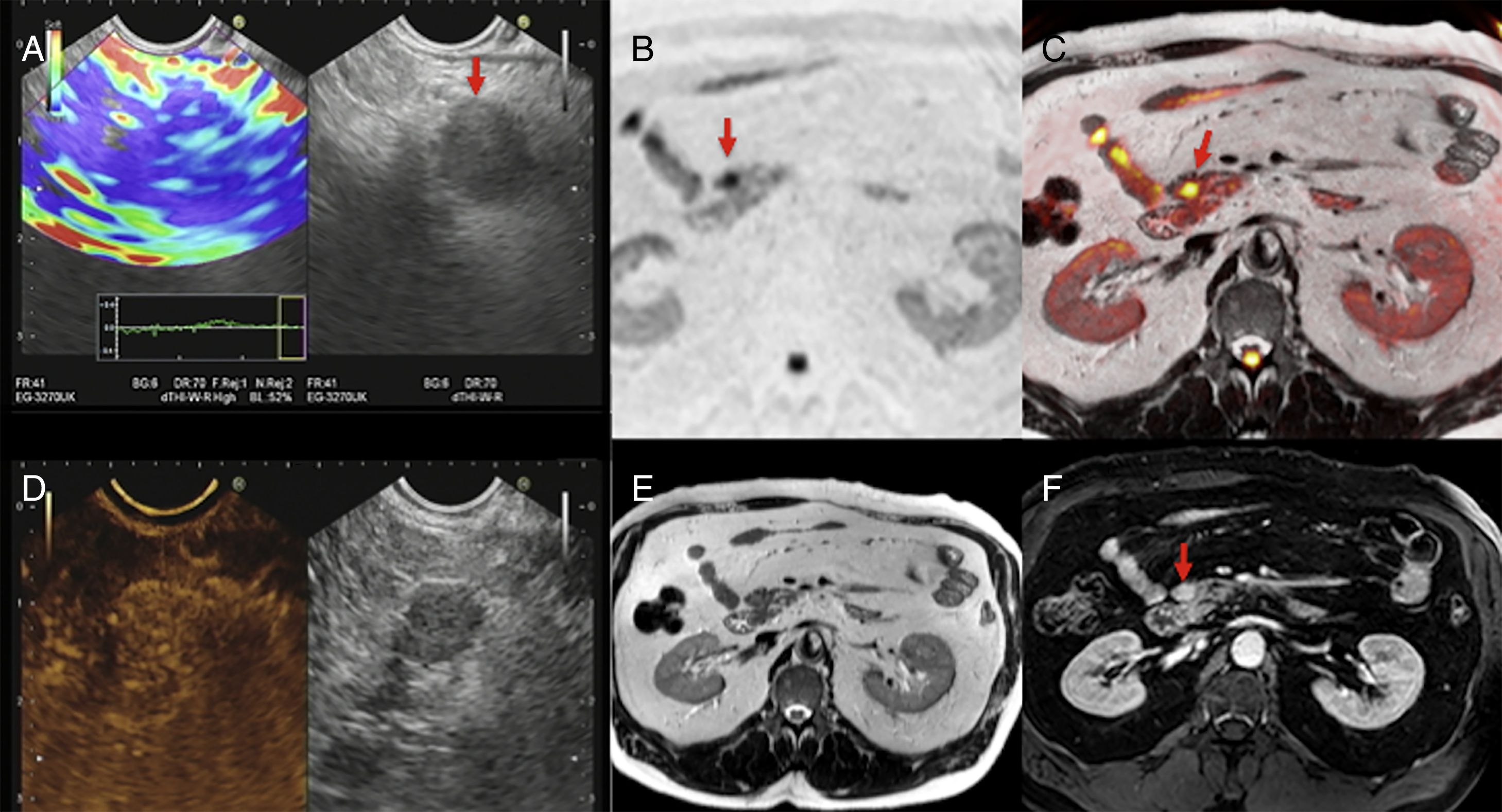 Imagen funcional de la patología pancreática | Radiología