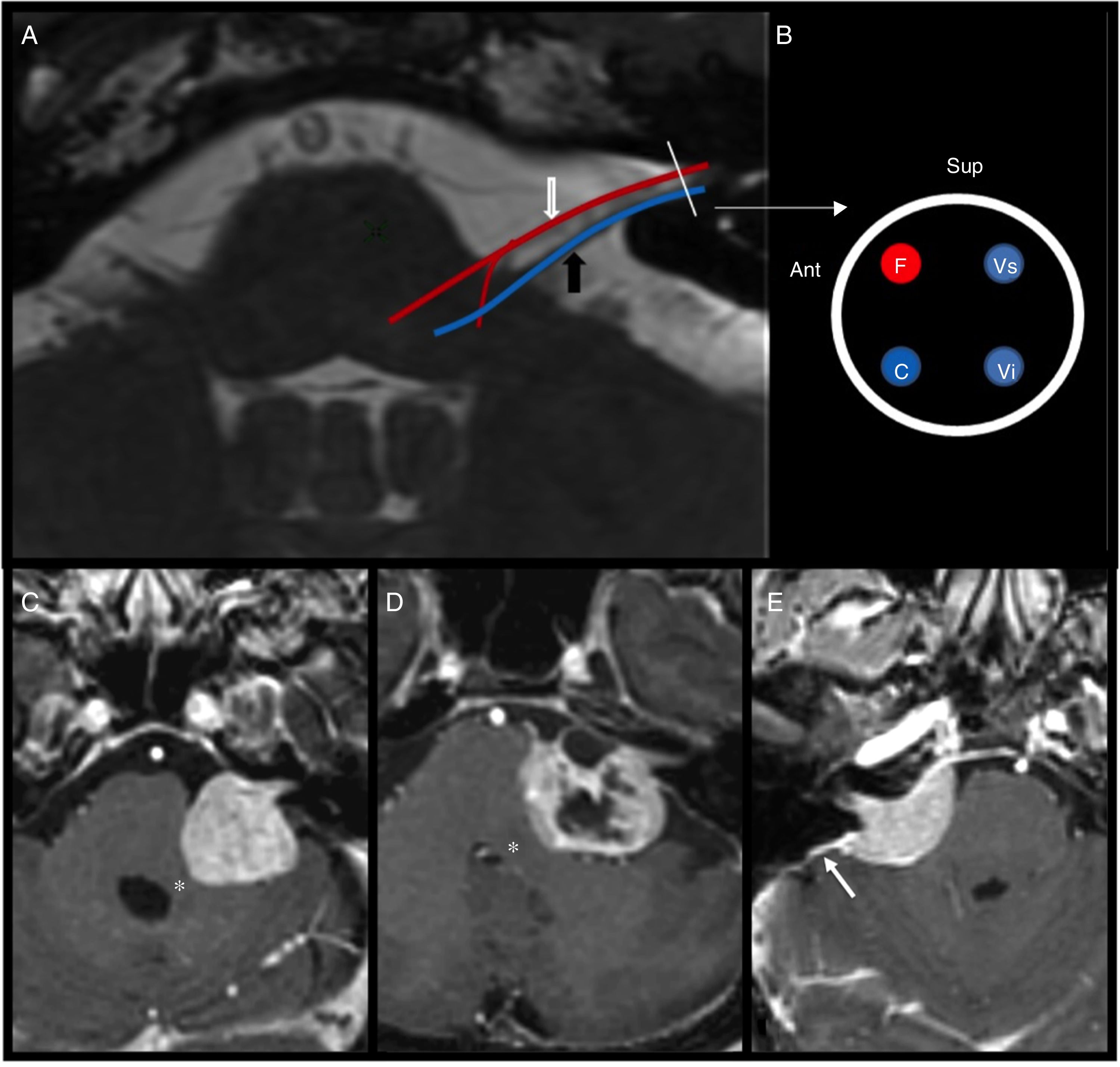 Sintomatología derivada de los pares craneales: Clínica y topografía ...