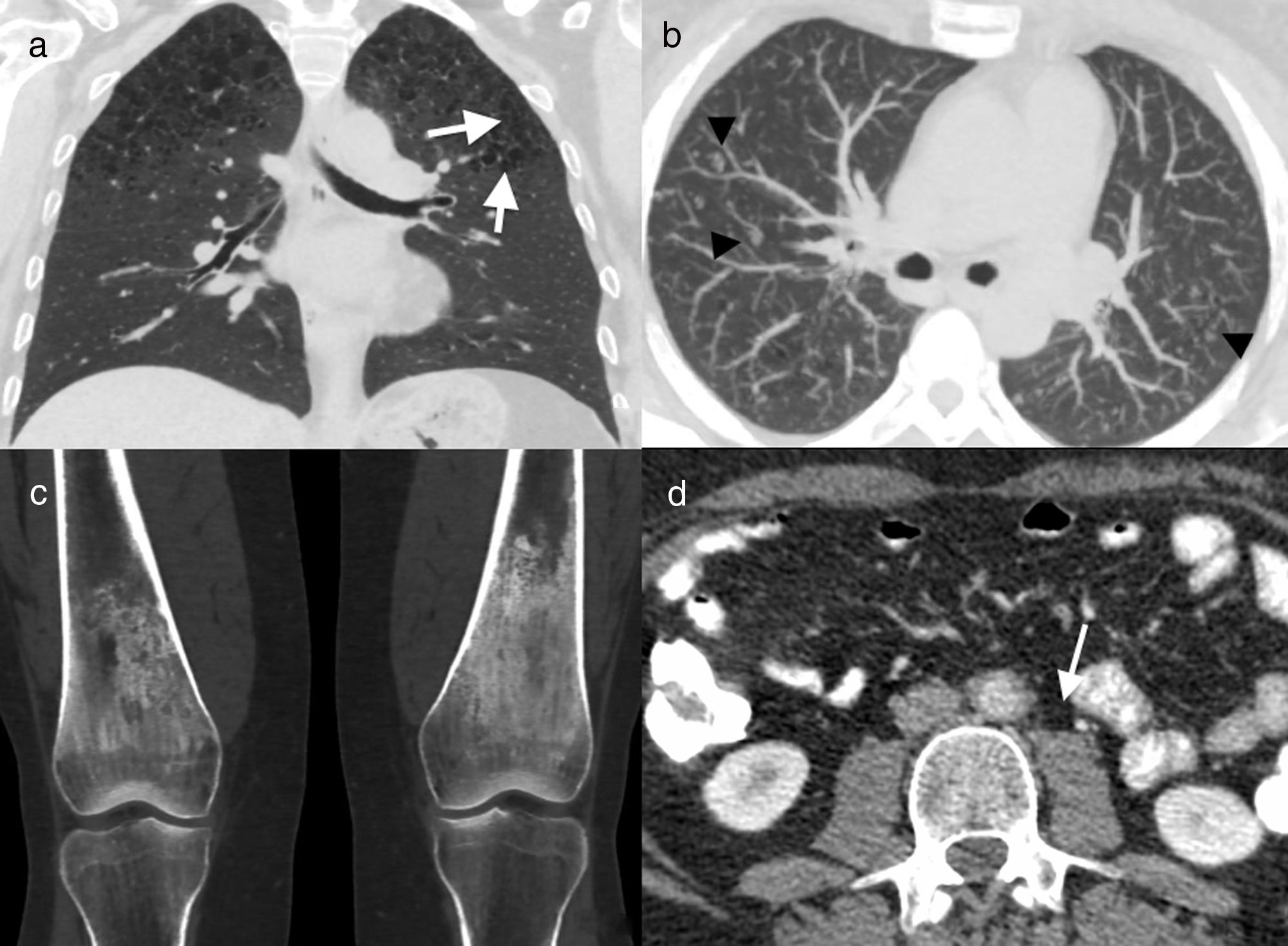 Histiocitosis pulmonar: más allá de la histiocitosis de células de ...