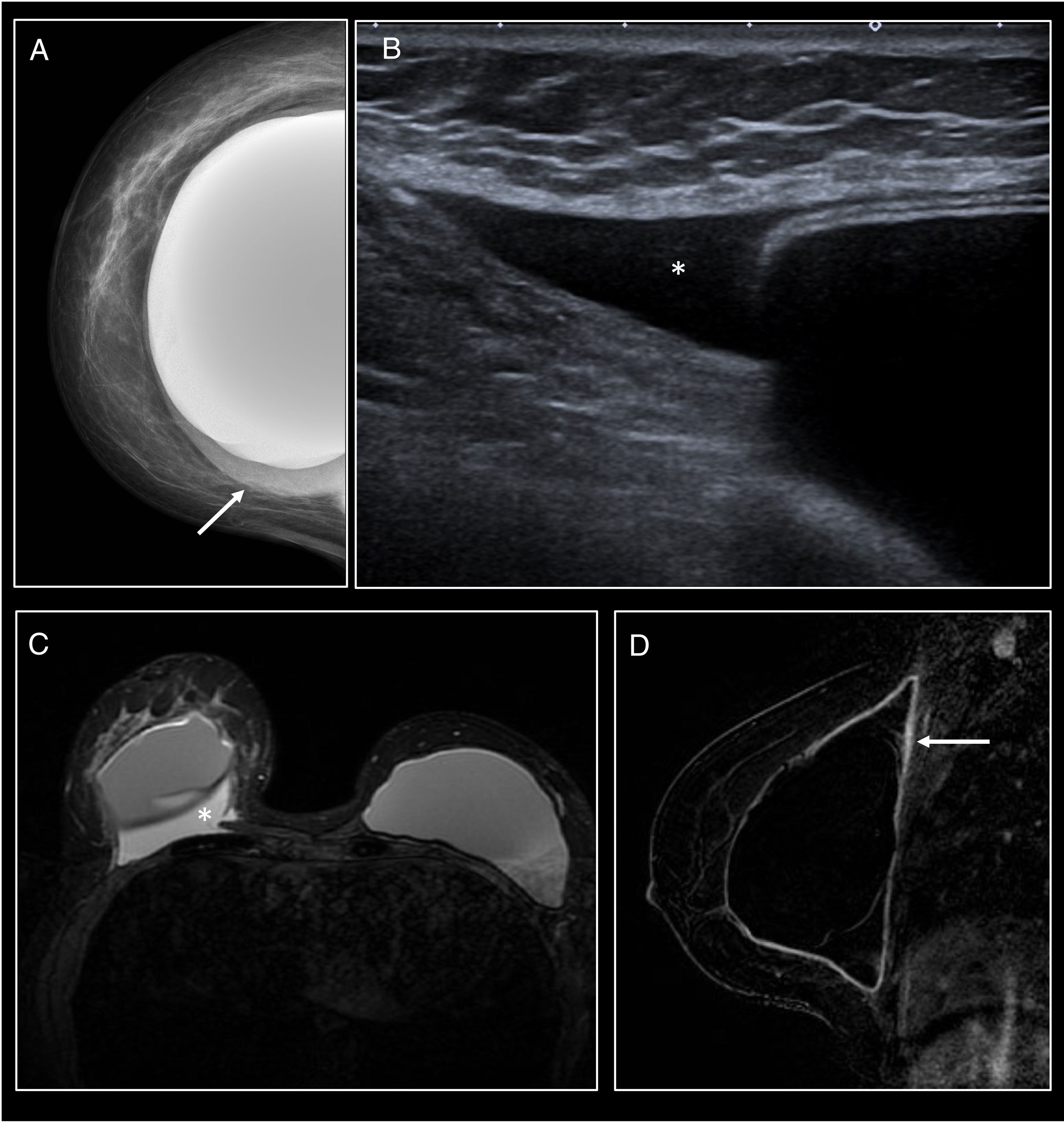 Complicaciones infrecuentes de las prótesis de mama | Radiología