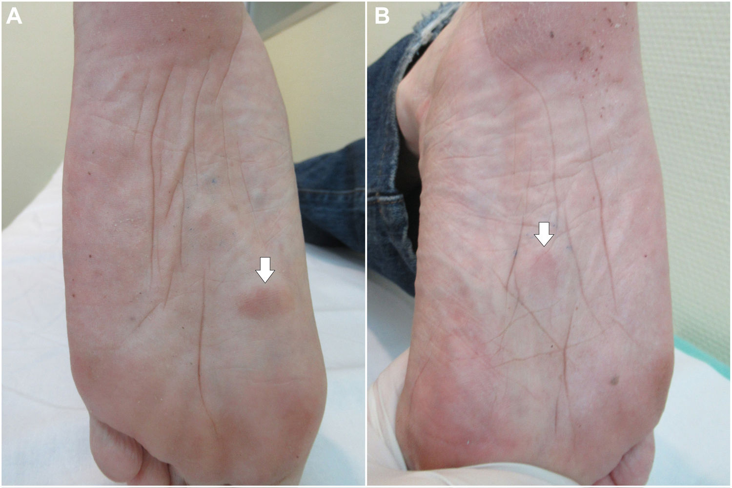 Fibromatosis plantar o enfermedad de Ledderhose: Diagnóstico ecográfico ...