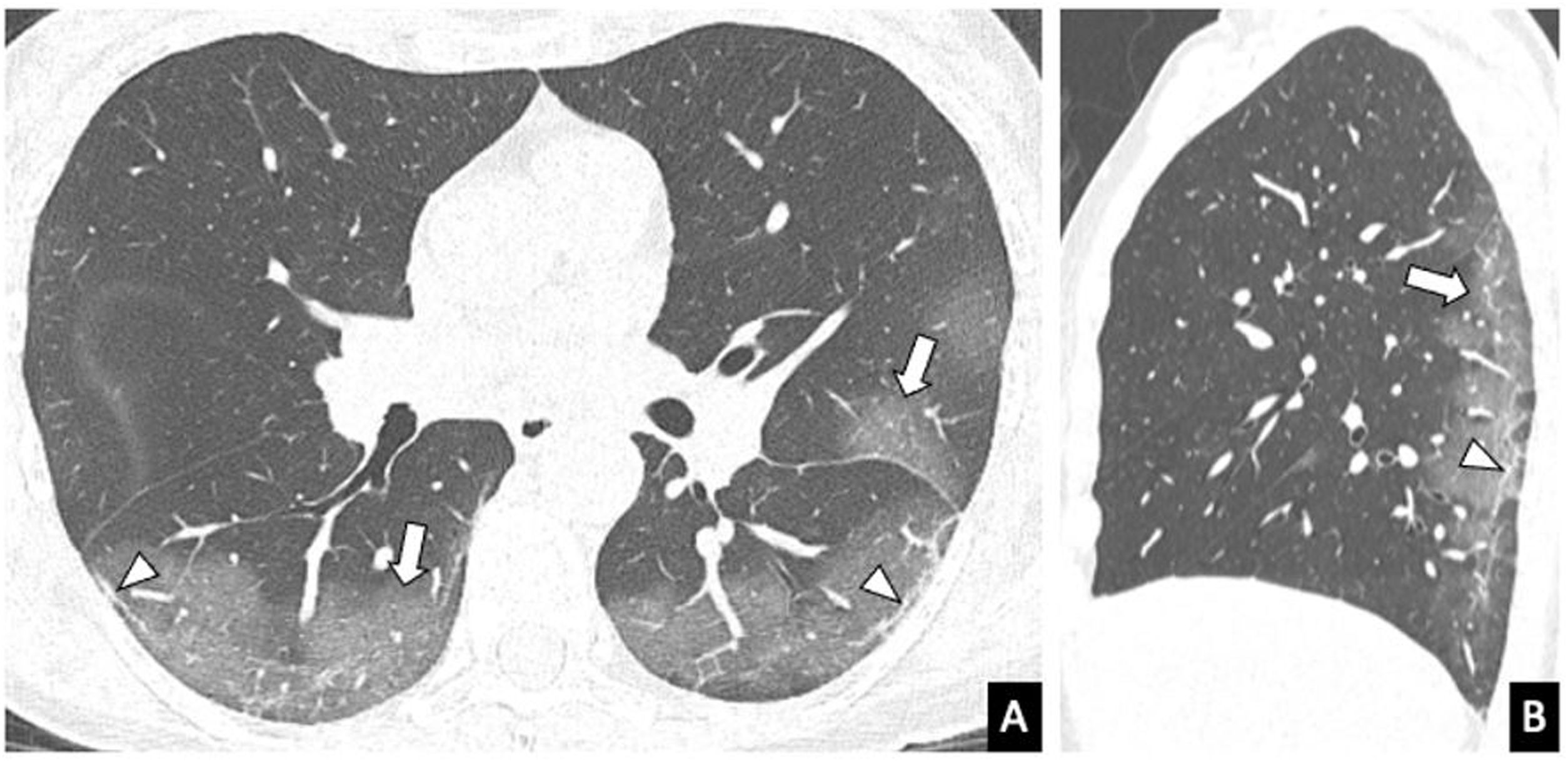 Hallazgos en la tomografía computarizada de tórax en las fases ...