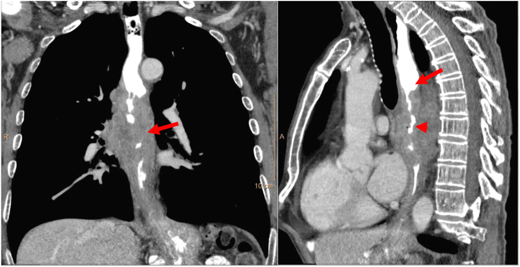 Cáncer de esófago: revisión actualizada del TNM y de sus complicaciones ...