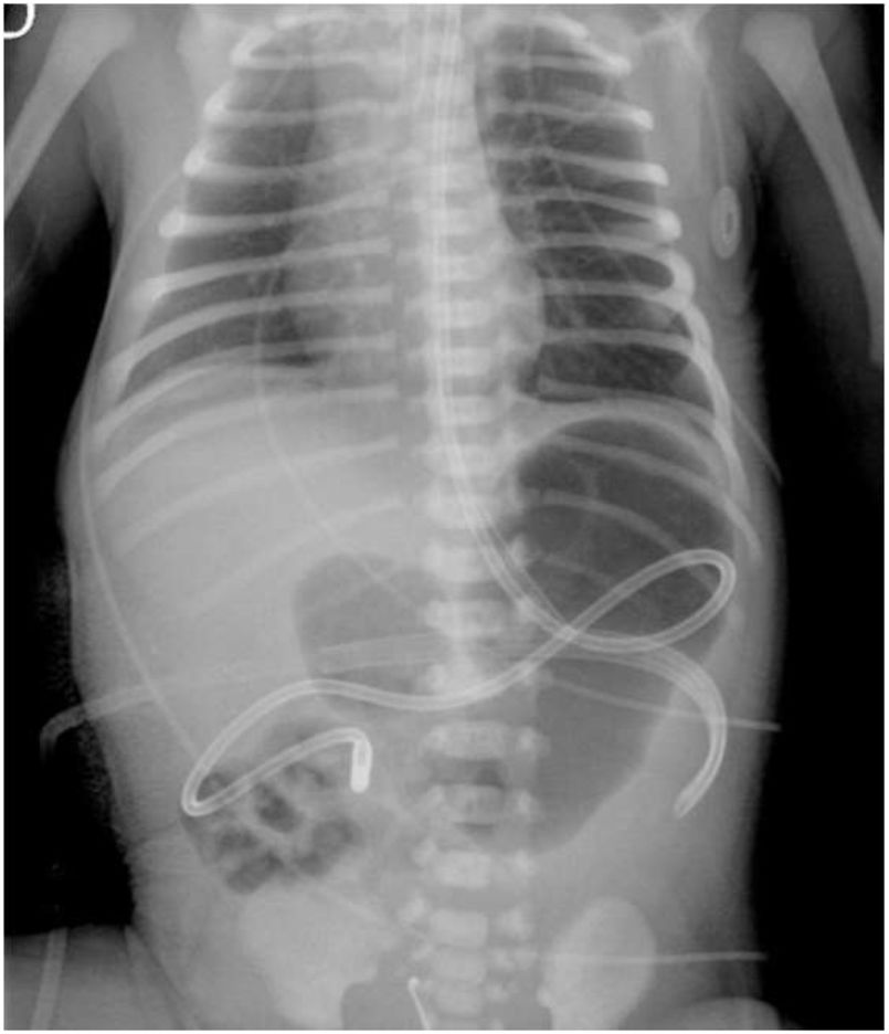 Atresias de intestino delgado. Revisión de la patología y hallazgos ...