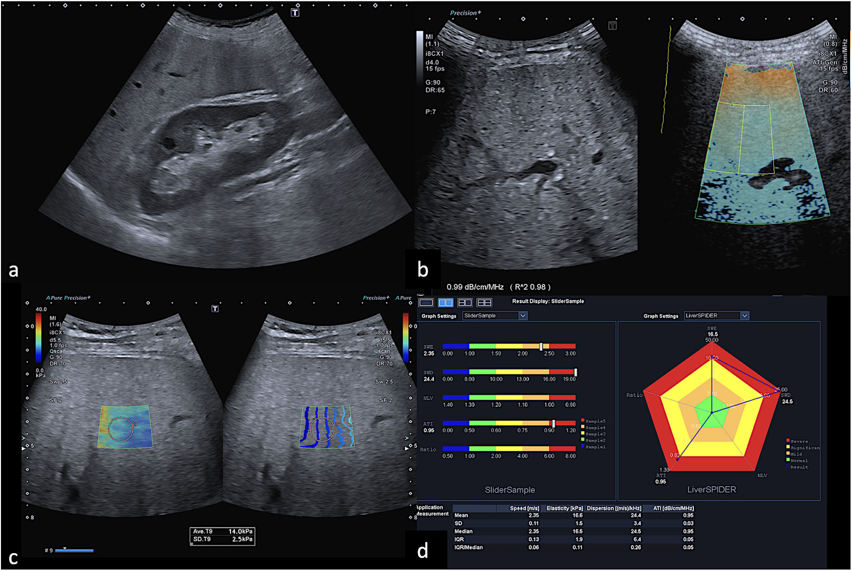 El informe radiológico en paciente con hepatopatía crónica | Radiología