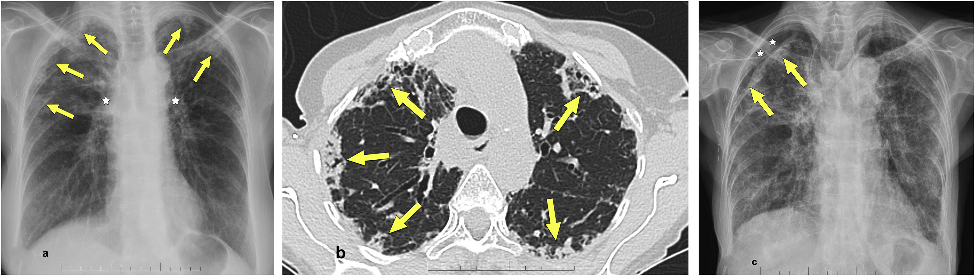 Fibroelastosis pleuroparenquimatosa idiopática (FEPPI) | Radiología