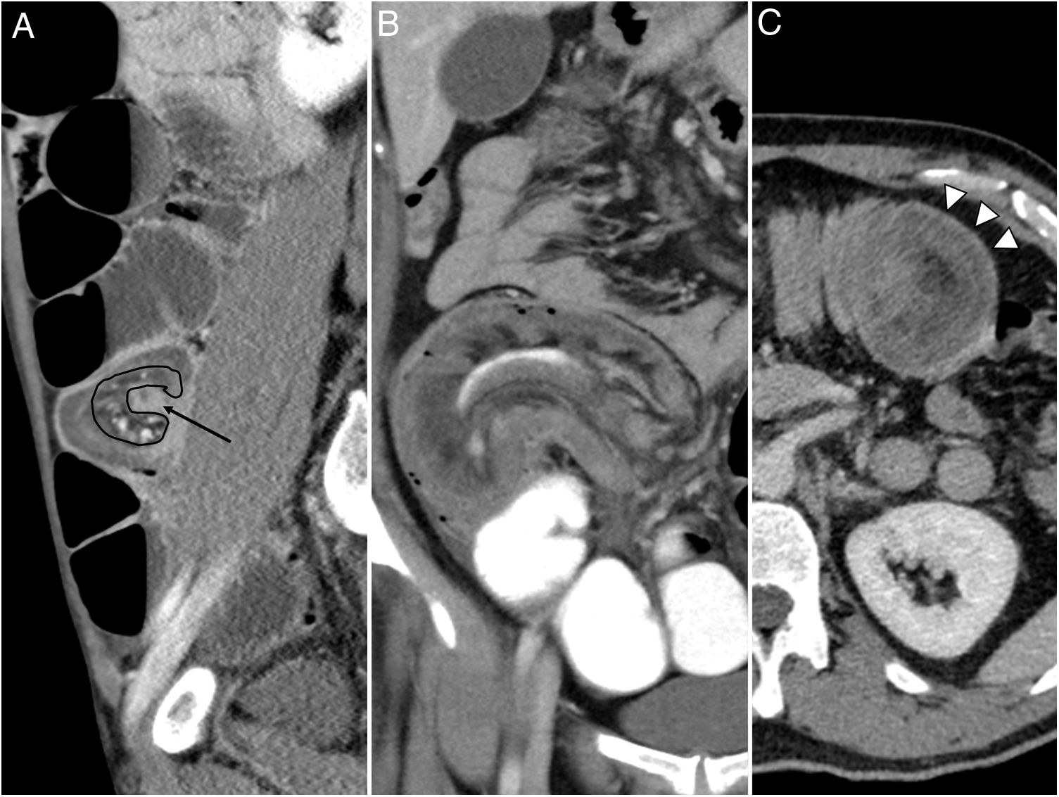 Invaginaciones intestinales en el adulto: localización, etiología ...