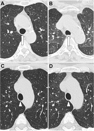TC torácica en espiración. Cuándo la hago y cómo la interpreto | Radiología