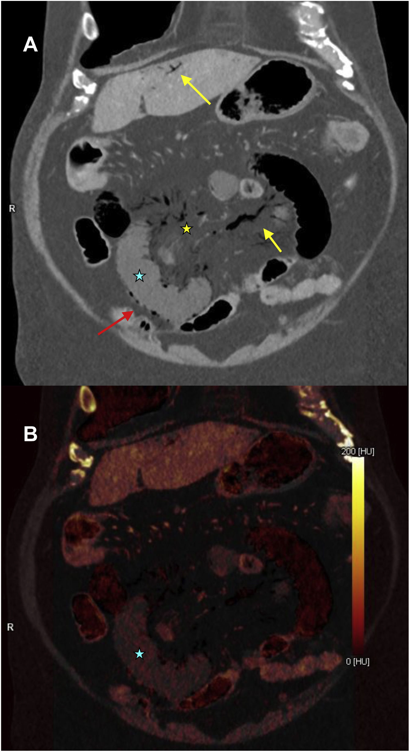 Obstrucción intestinal: signos de indicación quirúrgica urgente ...