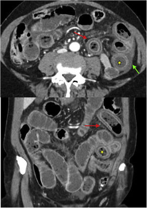 Obstrucción intestinal: signos de indicación quirúrgica urgente ...