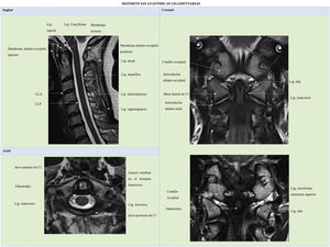 Traumatismo de la columna vertebral cervical | Radiología