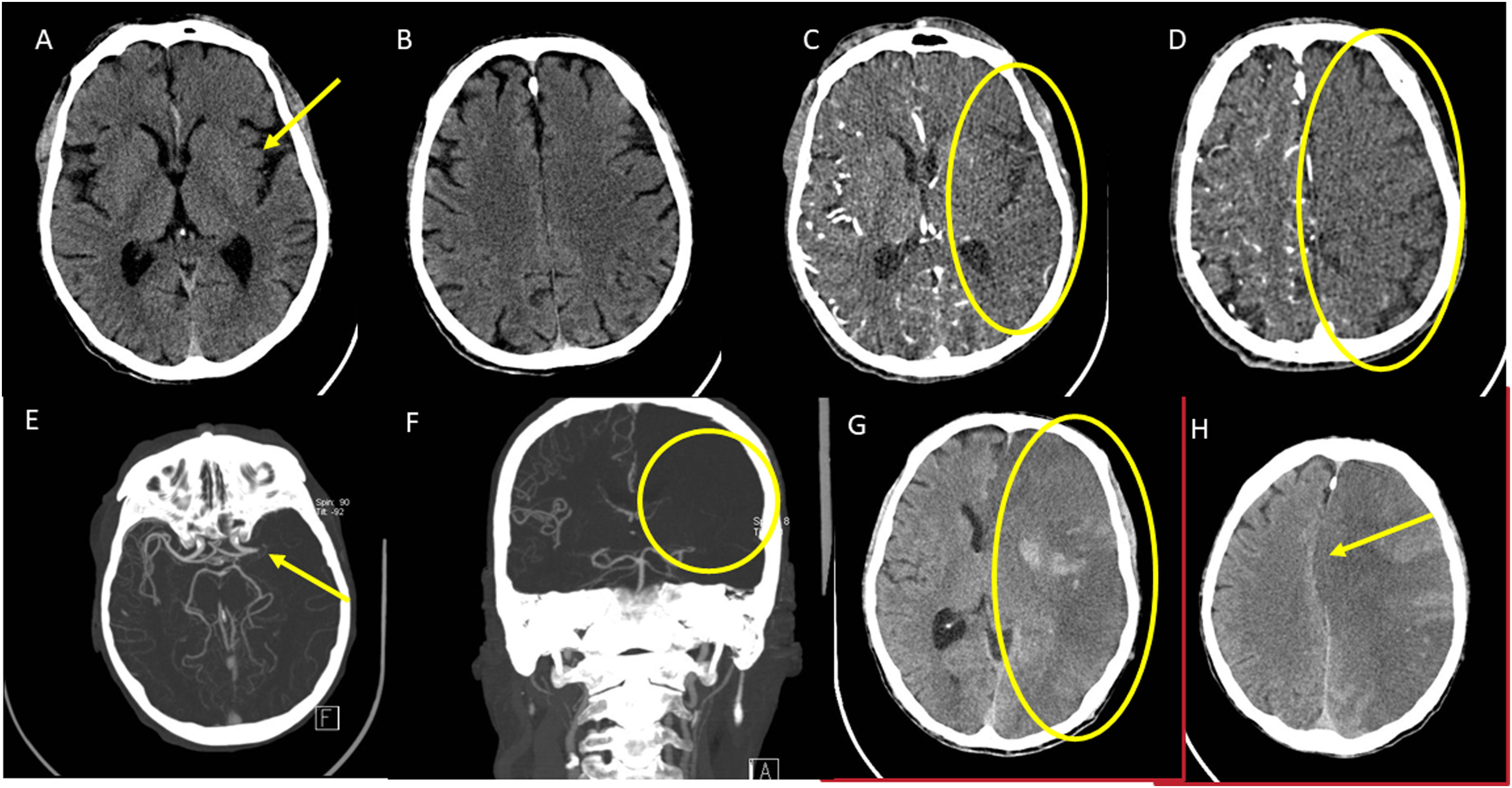 Actualización del código ictus en urgencias | Radiología