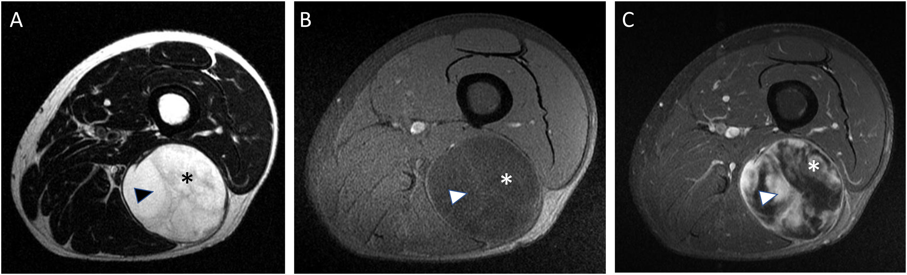 Liposarcoma mixoide: características por resonancia magnética con ...
