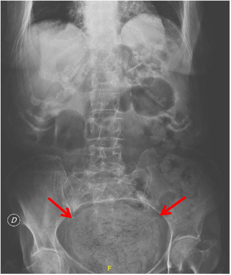 Análisis de la radiografía simple de abdomen en la urgencia de un ...