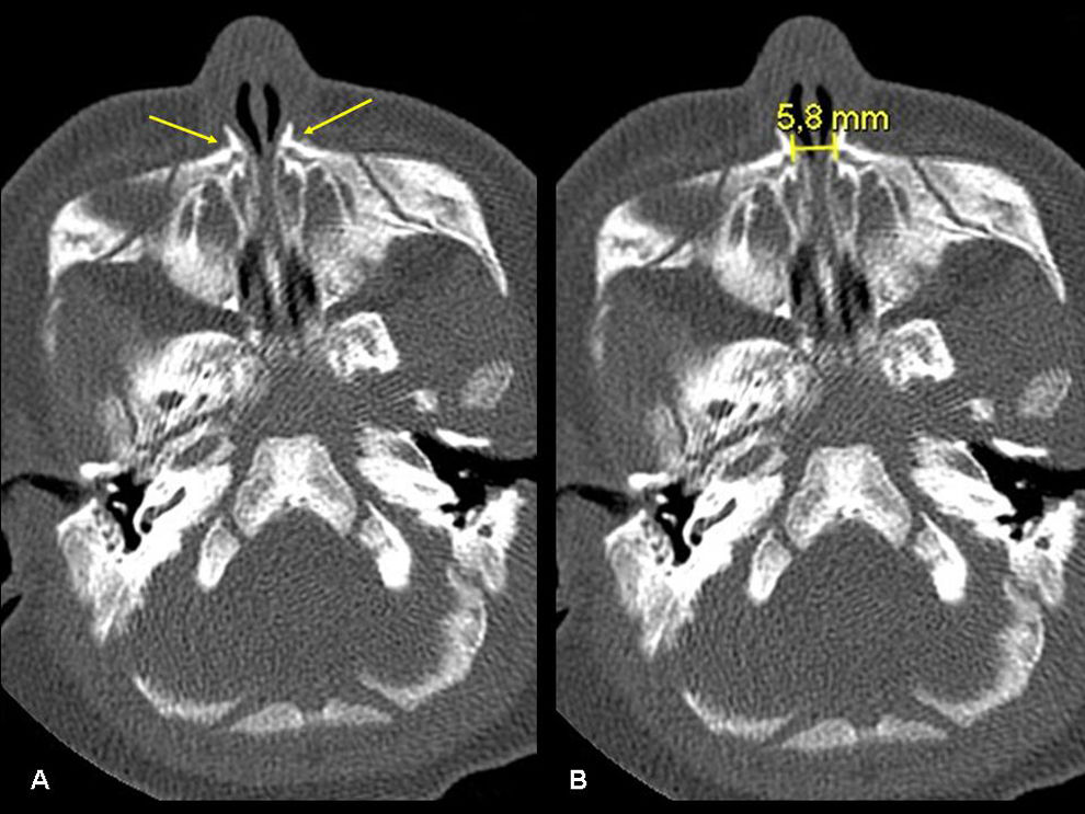 Estenosis congénita de la apertura piriforme | Radiología