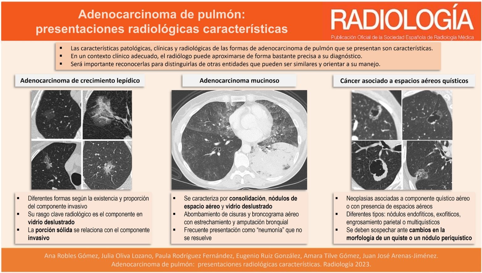 Adenocarcinoma de pulmón: Presentaciones radiológicas características ...