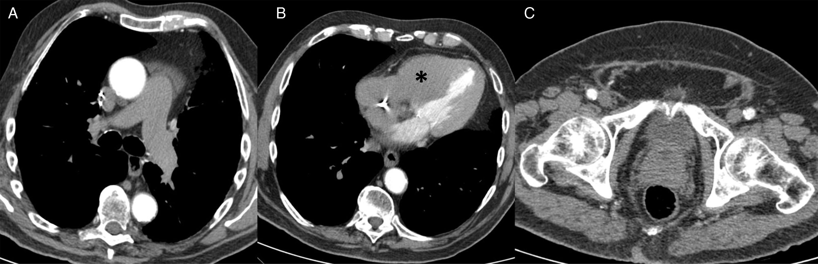 Optimización del uso del contraste yodado en las exploraciones de TC ...