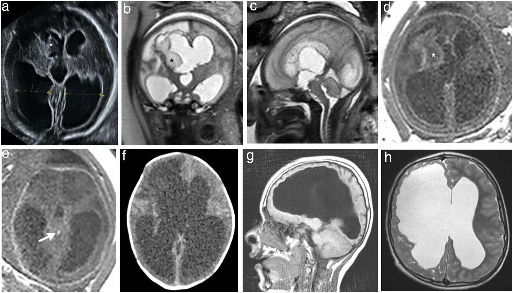 Resonancia magnética de la ventriculomegalia cerebral fetal | Radiología