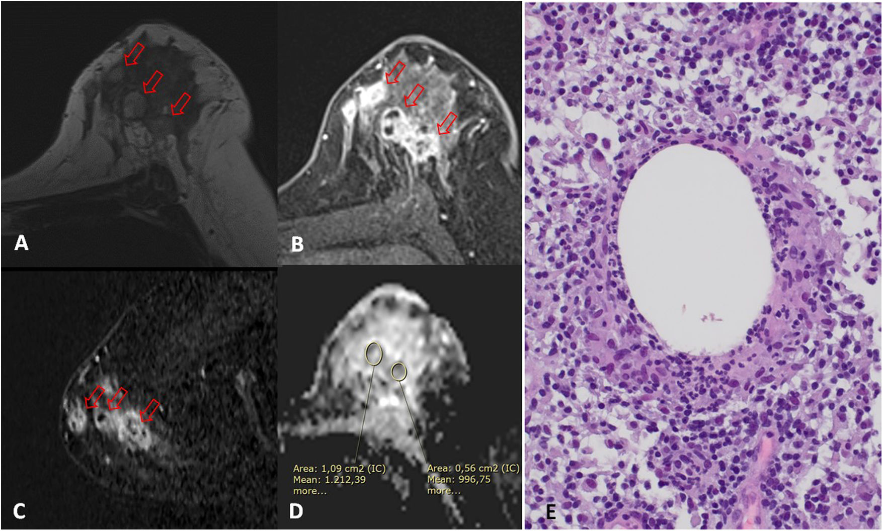 Hallazgos por resonancia magnética de las mastitis inflamatorias de ...