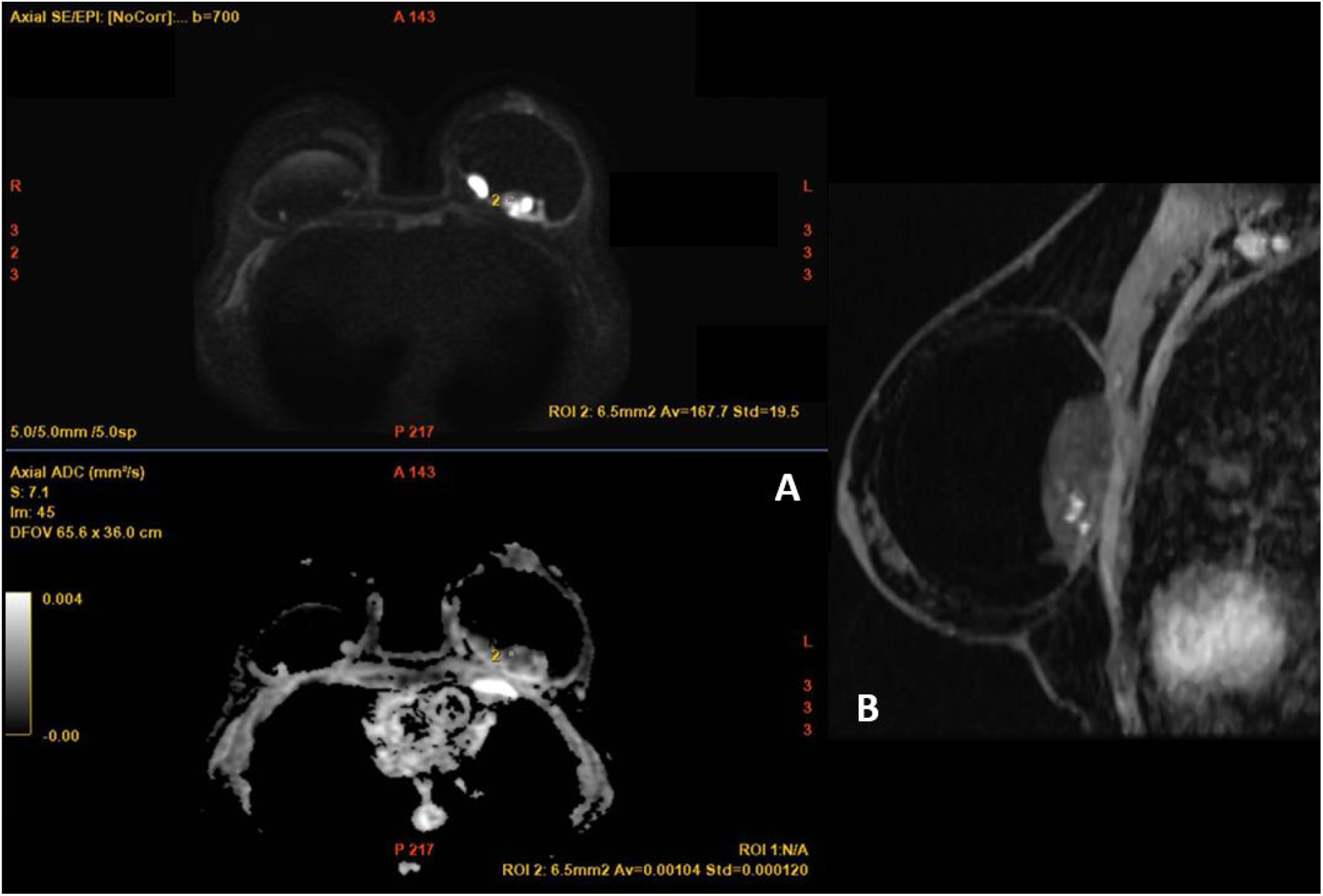 Tumor de Masson en la mama: un reto diagnóstico | Radiología