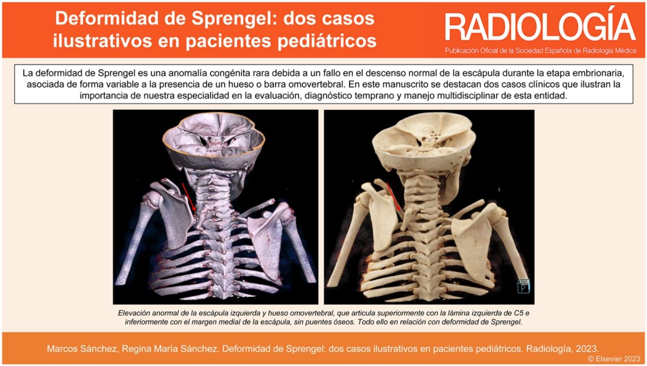 Deformidad de Sprengel: dos casos ilustrativos en pacientes pediátricos ...