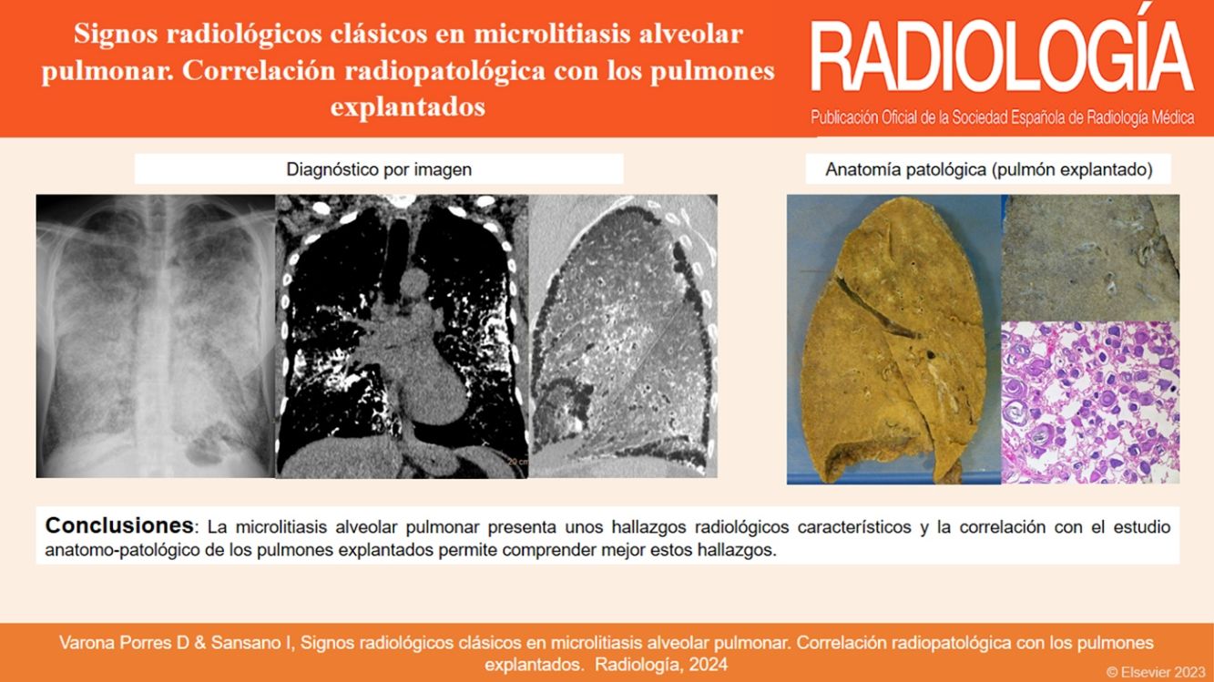 Signos radiológicos clásicos en microlitiasis alveolar pulmonar ...