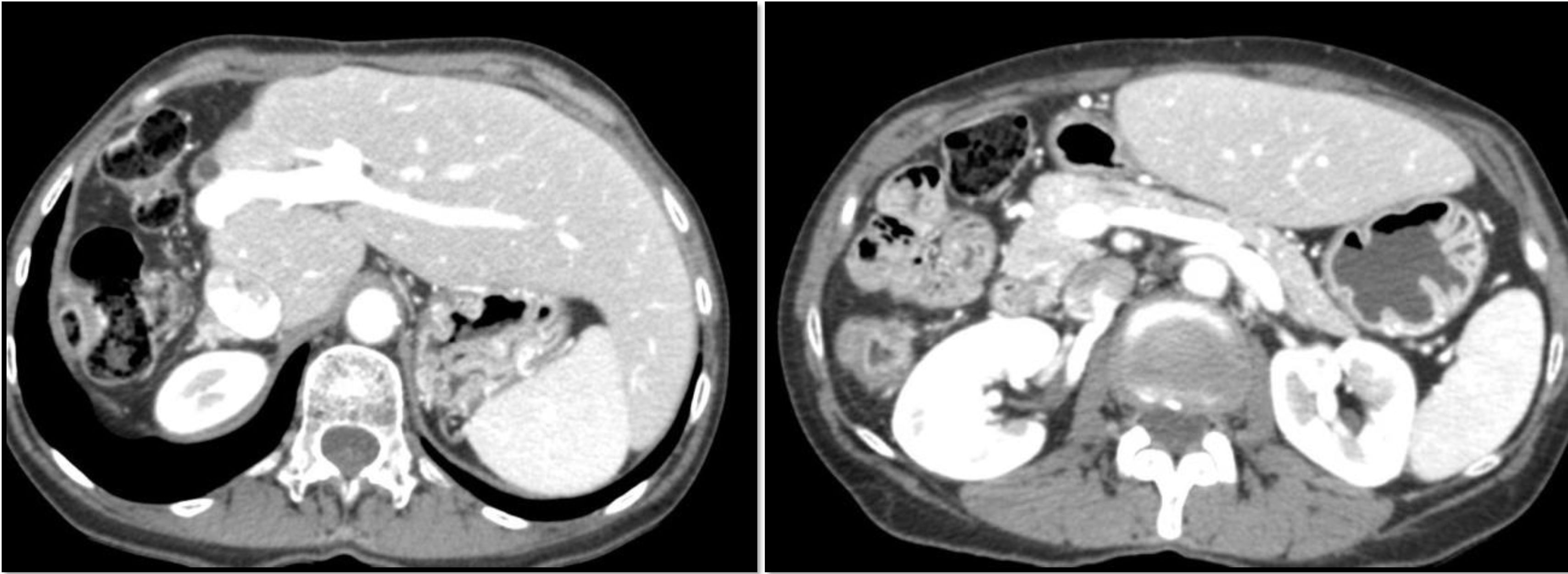 Optimización del uso del contraste yodado en las exploraciones de TC ...