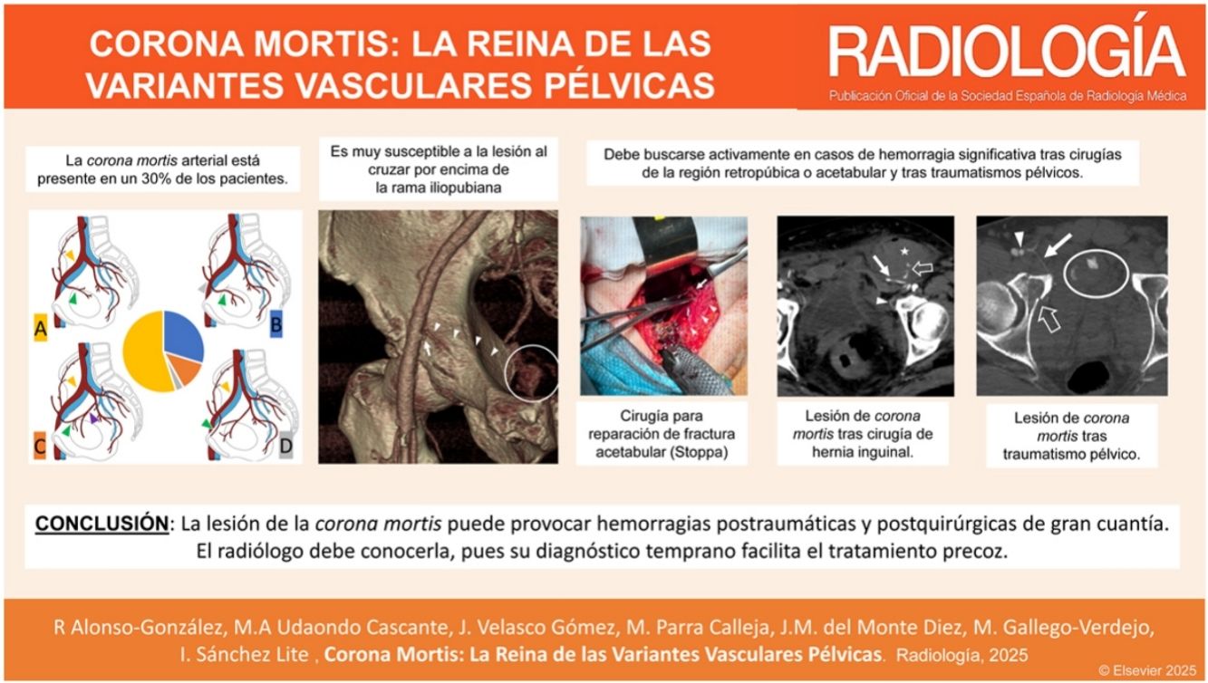 Corona mortis: la reina de las variantes vasculares pélvicas | Radiología