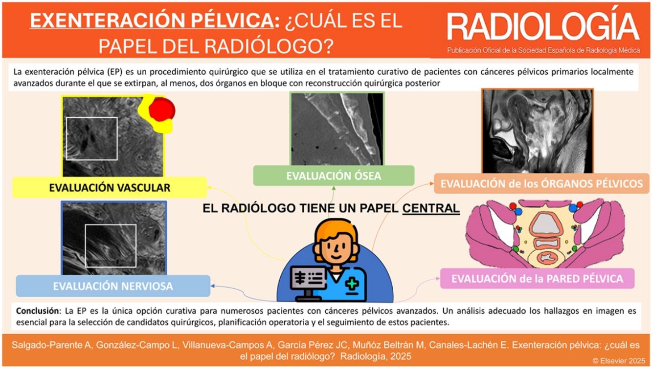 Exenteración pélvica: ¿cuál es el papel del radiólogo? | Radiología