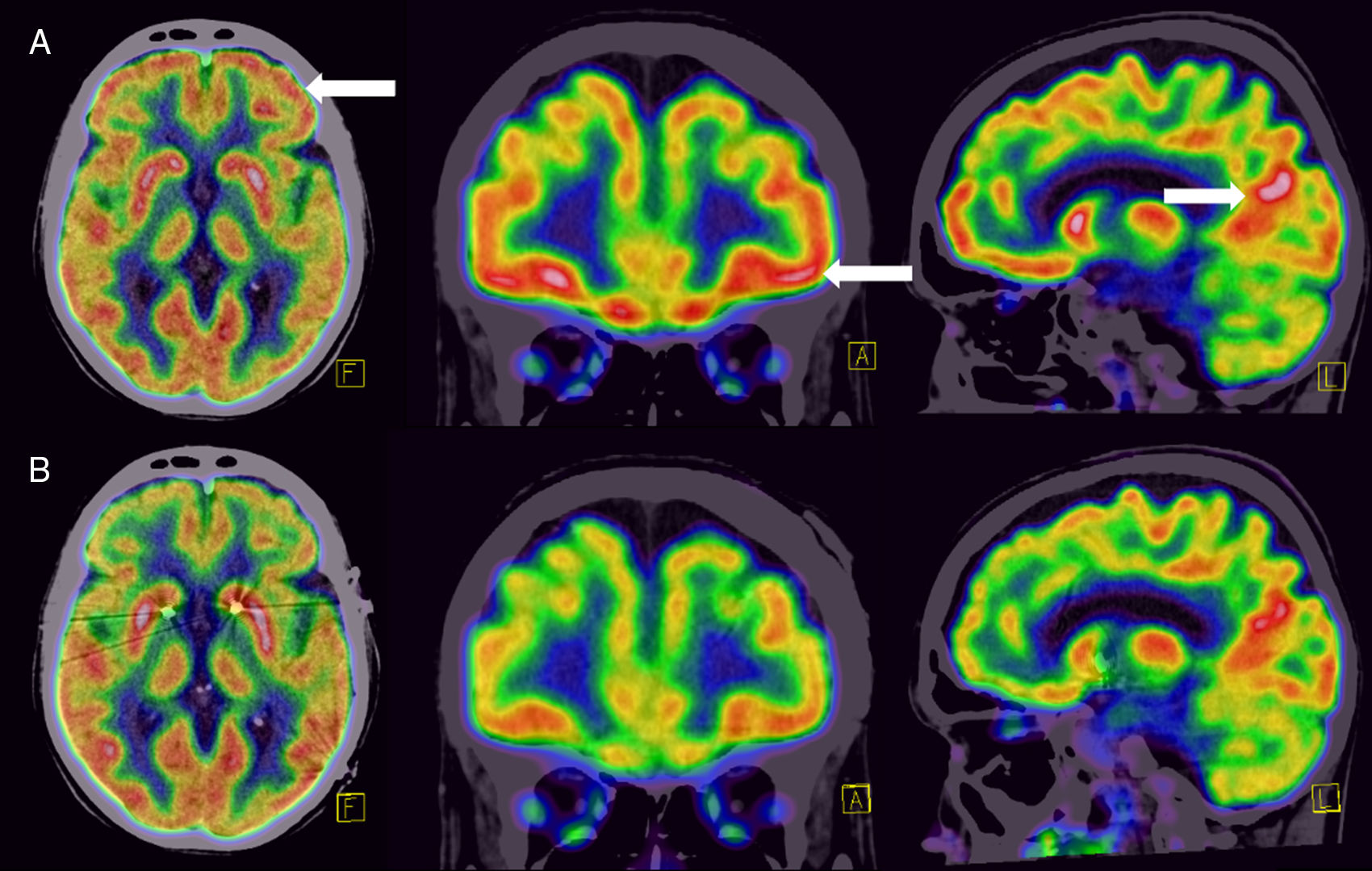 Deep-brain stimulation in treatment-resistant obsessive-compulsive ...